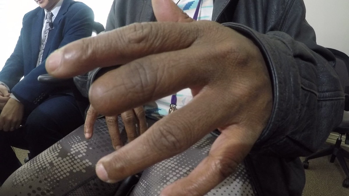 Lawsuit Womans Finger Infected Amputated After Visit To Fort Worth