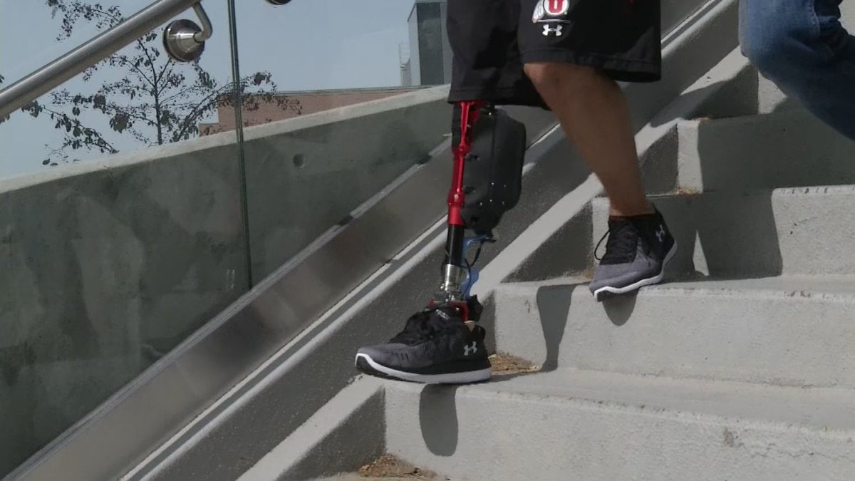 World’s First Truly Bionic Leg: Better, Stronger, Faster – NBC 5 Dallas ...