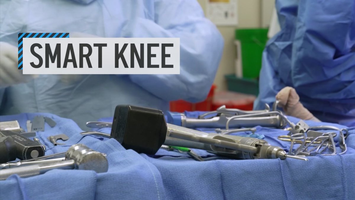 ‘Smart Knee’ Replacement: The Connection – NBC 5 Dallas-Fort Worth
