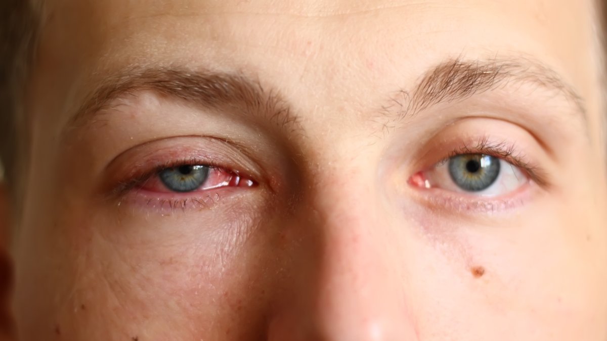 What Is Pink Eye? – NBC 5 Dallas-Fort Worth