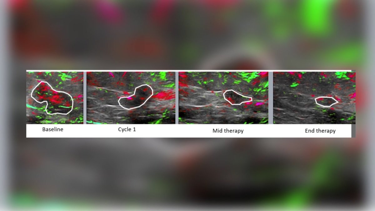 New Imaging Changes Waxahachie Woman’s Outlook on Cancer Journey – NBC ...