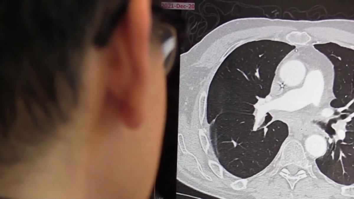 Lifesaving Double Lung Transplant – NBC 5 Dallas-Fort Worth