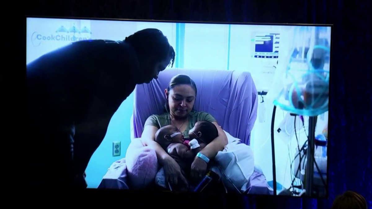 Cook Children’s Announces Conjoined Twin Girls Separated in Rare ...