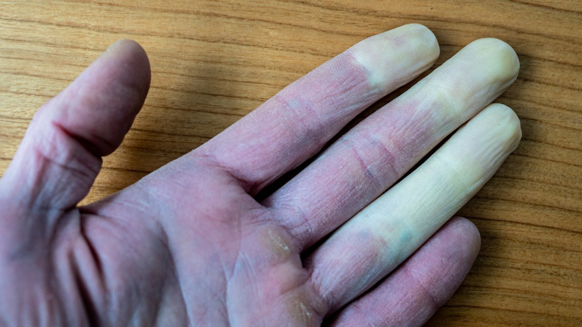 What Is Raynaud’s Disease? – NBC 5 Dallas-Fort Worth