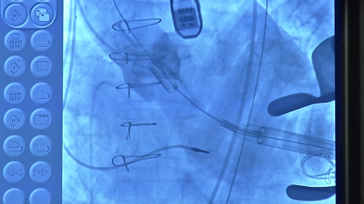New Device Helps Right Side of Heart After Heart Failure – NBC 5 Dallas ...