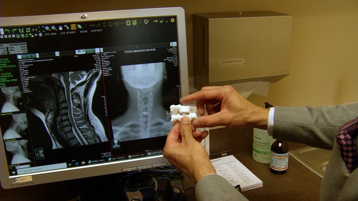 Cervical disk replacement saves necks and relieves pain – NBC 5 Dallas ...