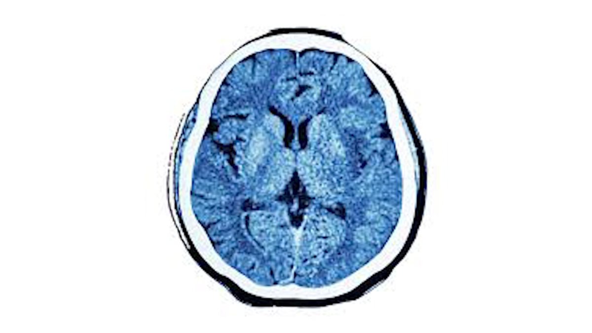 Ketamine to Heal Kids’ Brains? – NBC 5 Dallas-Fort Worth