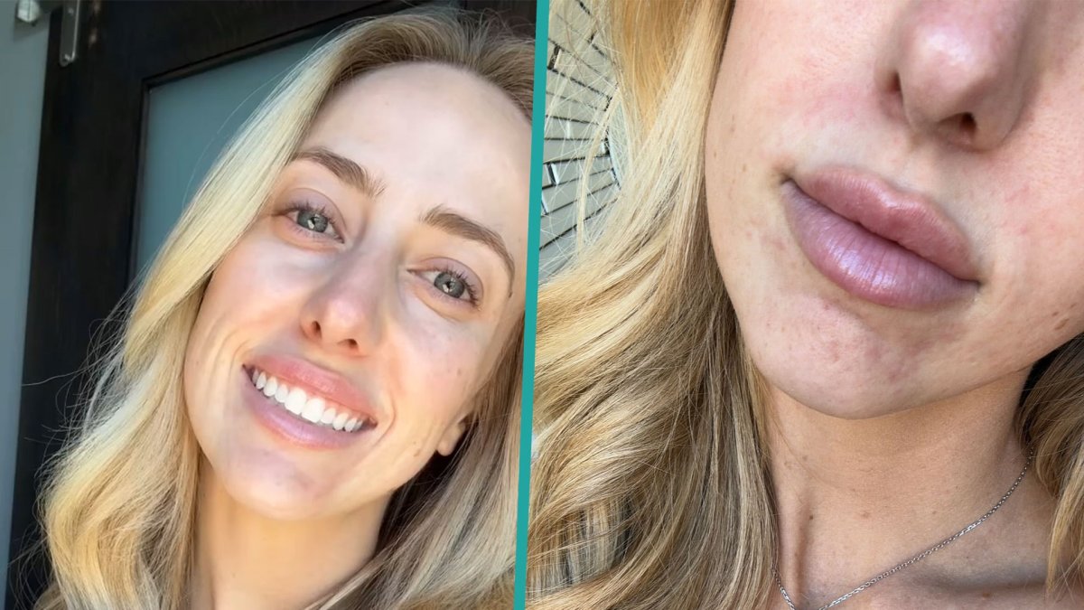 Brittany Mahomes gets real about flaring acne in makeup-less selfies ...