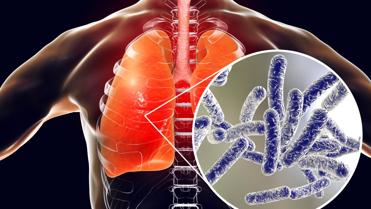 What is Legionnaires’ disease? How you get it, symptoms, treatment ...
